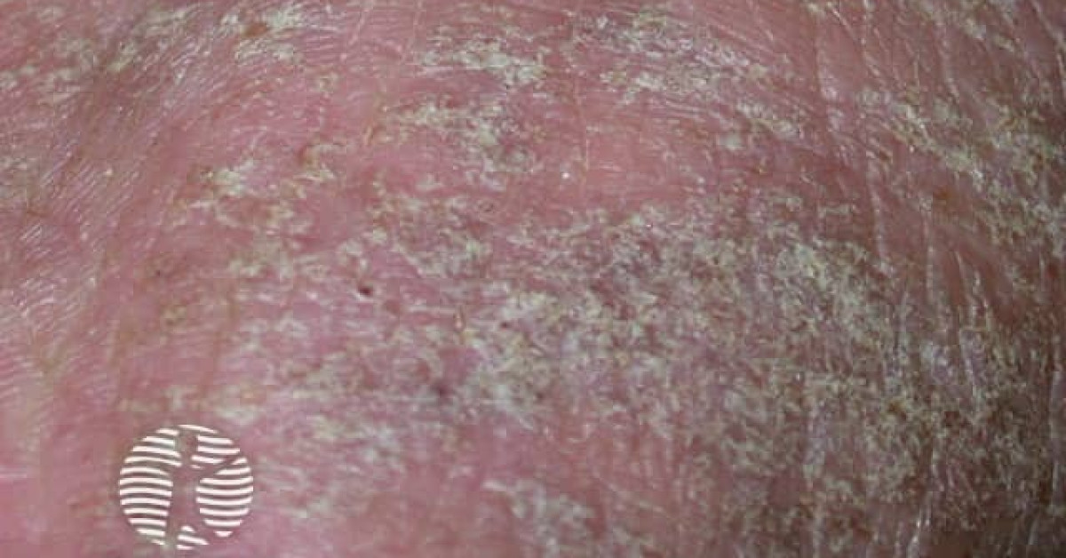 Scabies image