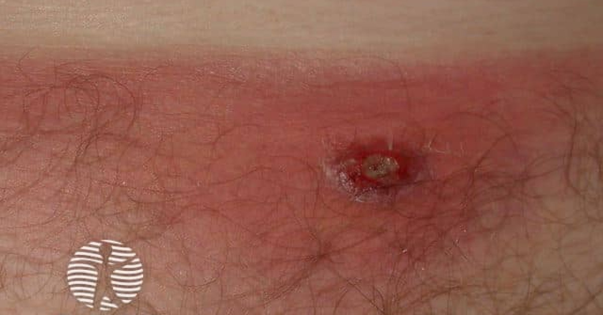 abscess2 image