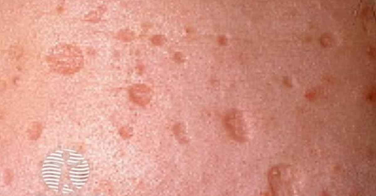 chickenpox scars s image