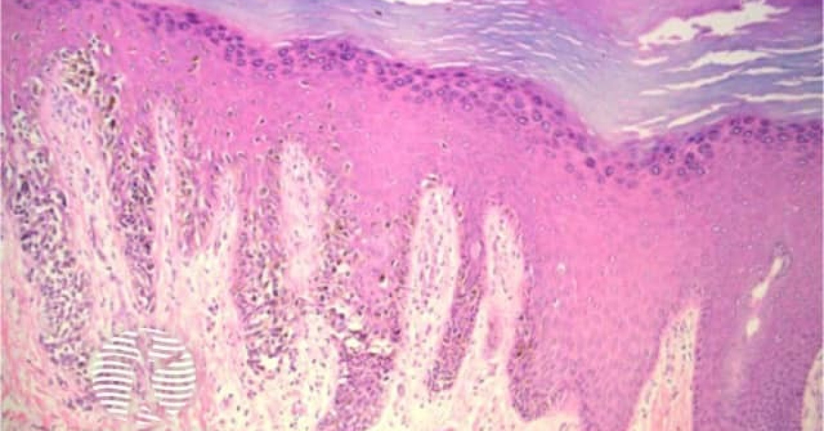 acral-melanoma-path28.jpg image