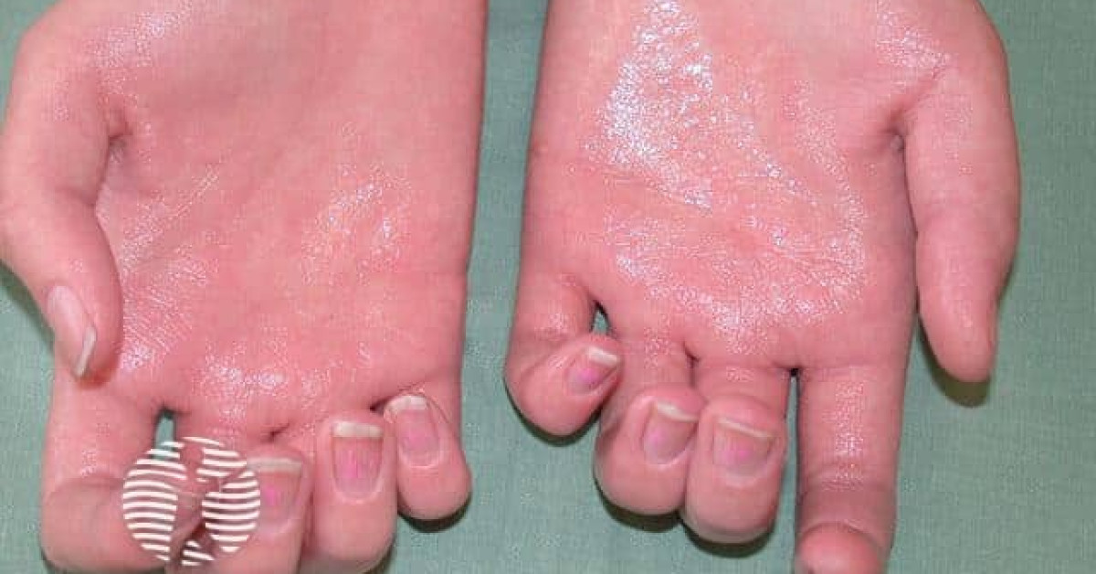 hyperhidrosis3 image