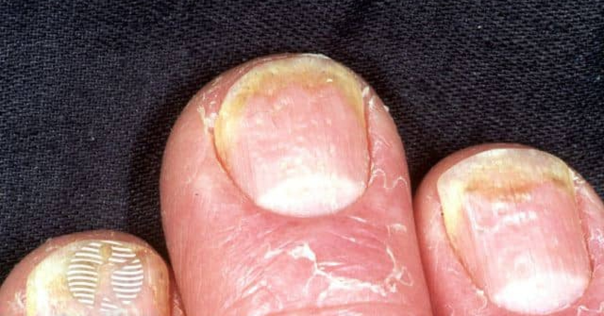 Nail pitting, ridging, onycholysis image