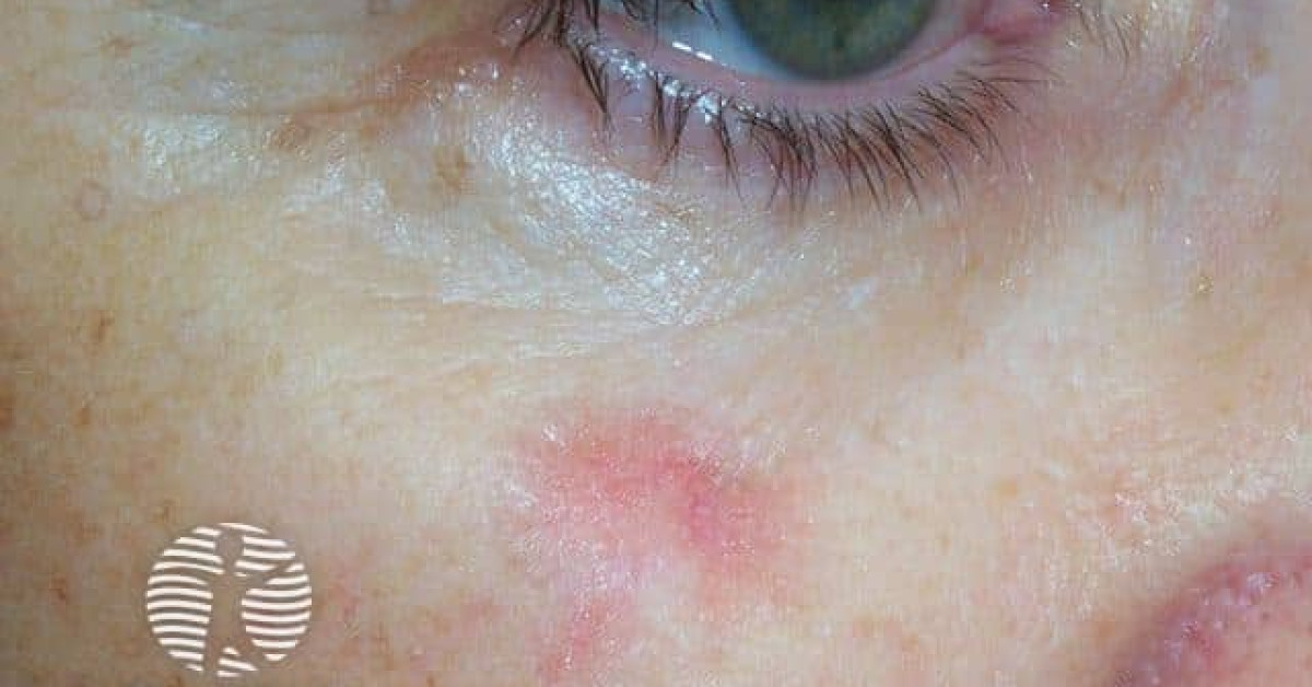 lichenoid keratosis1 image