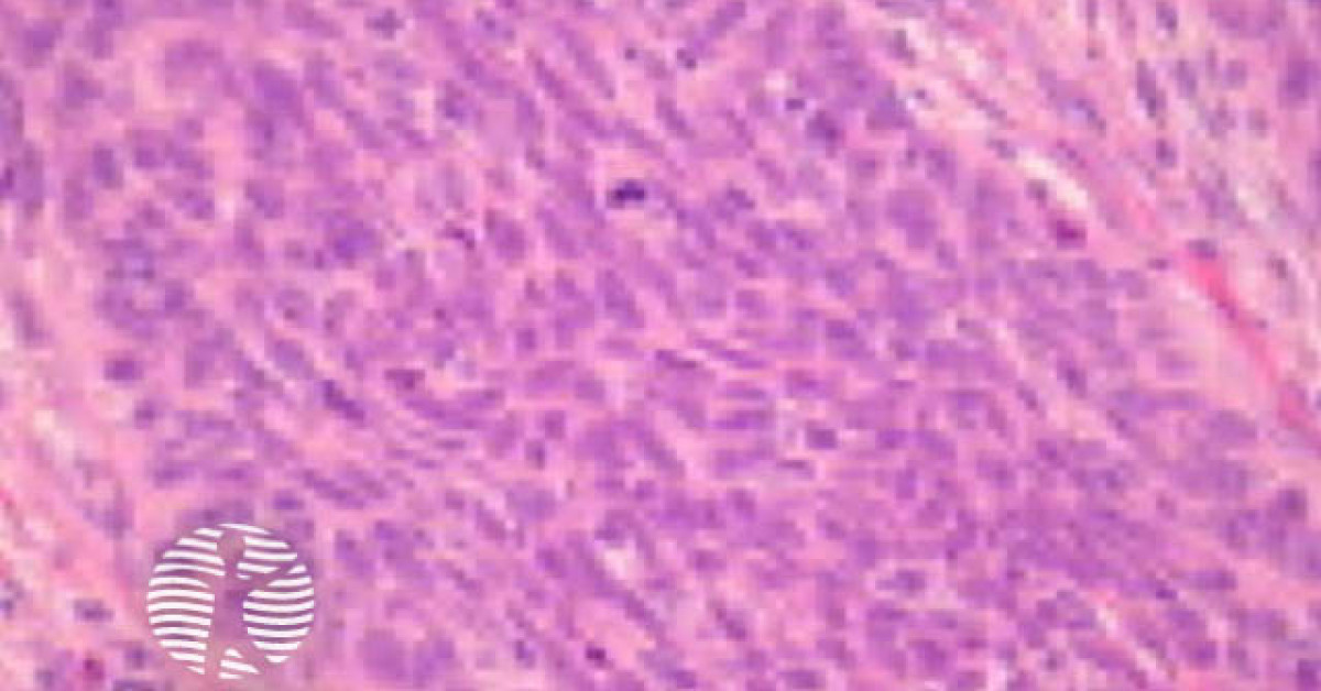 basaloid scc fig 34 sm image