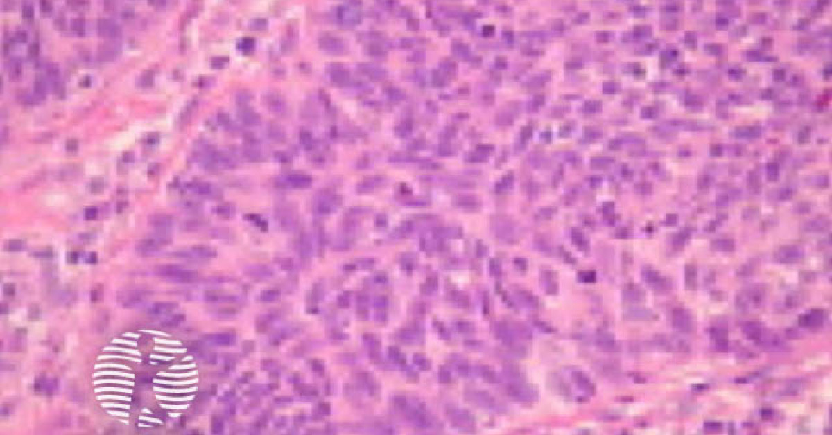 basaloid scc fig 35 sm image