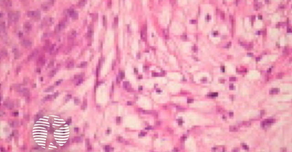 clear cell scc fig 13 sm image