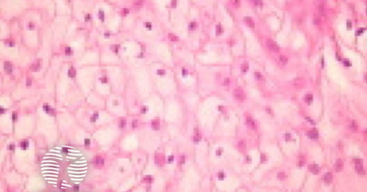 clear cell scc fig 14 sm image