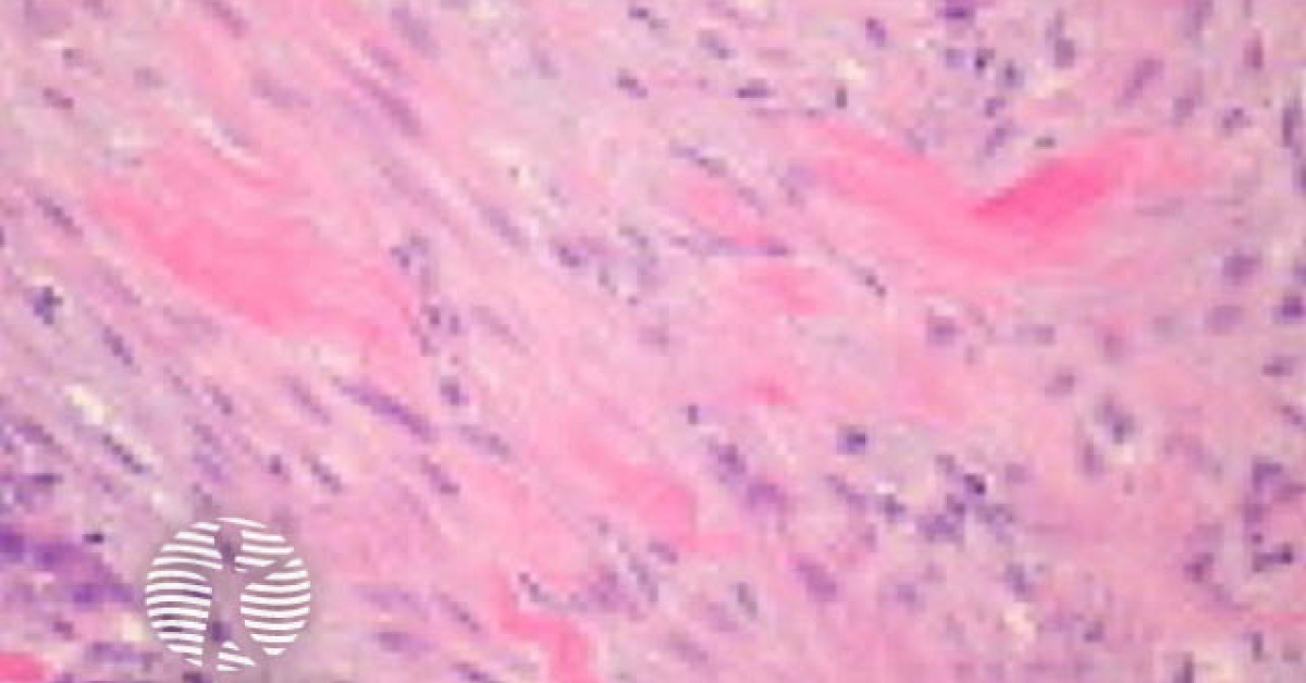 desmoplastic scc fig 15 sm image