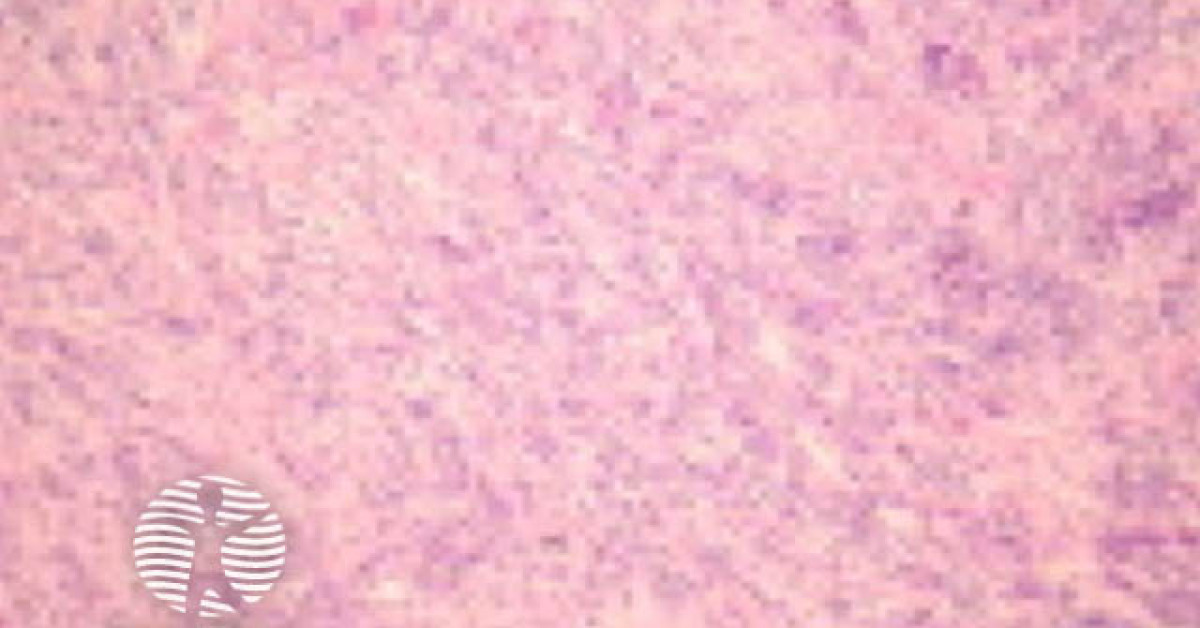 spindle cell scc fig 11 sm image