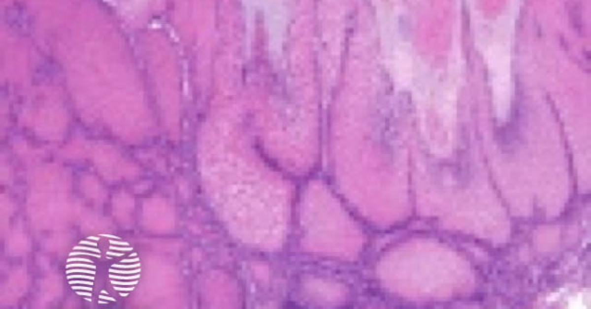 verrucous scc 17a sm image