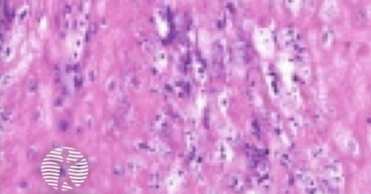 verrucous scc 18b sm image