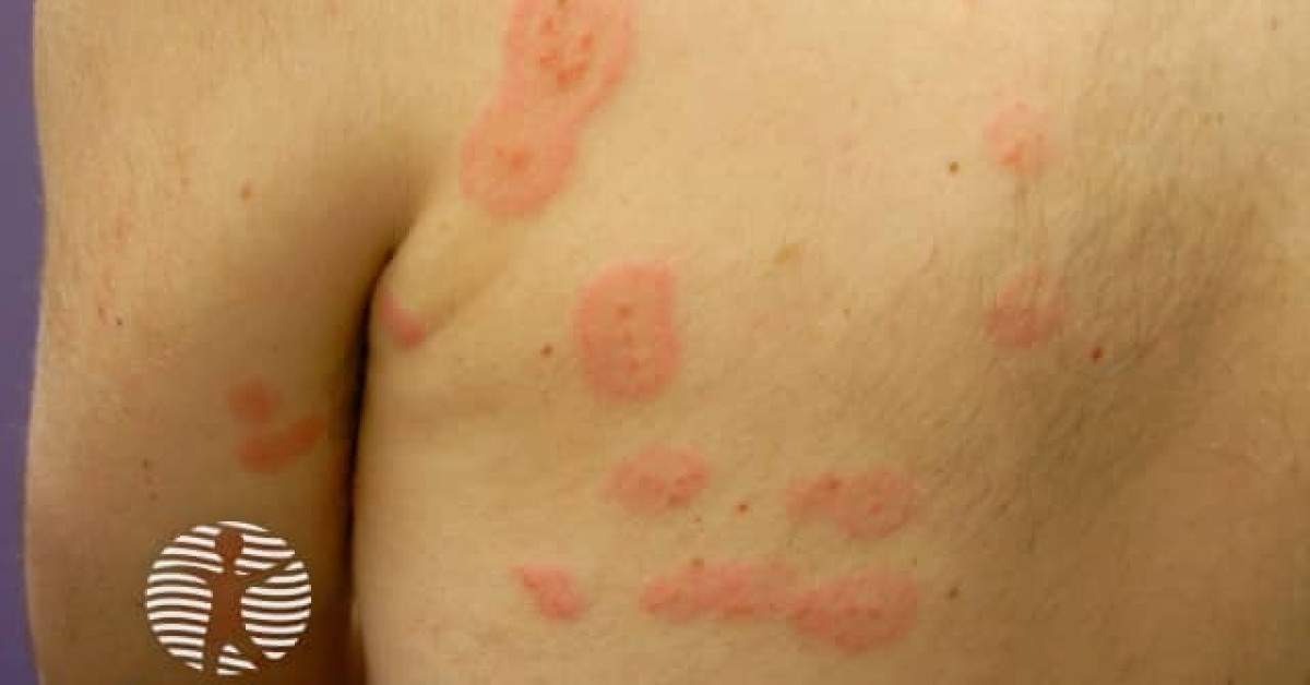 DermNet® - sweet14 image