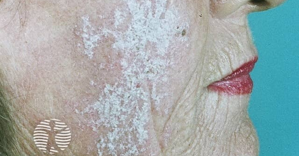 facial psoriasis18 image