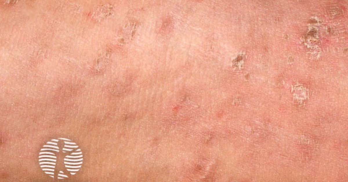 pityriasis lichenoides1 s image