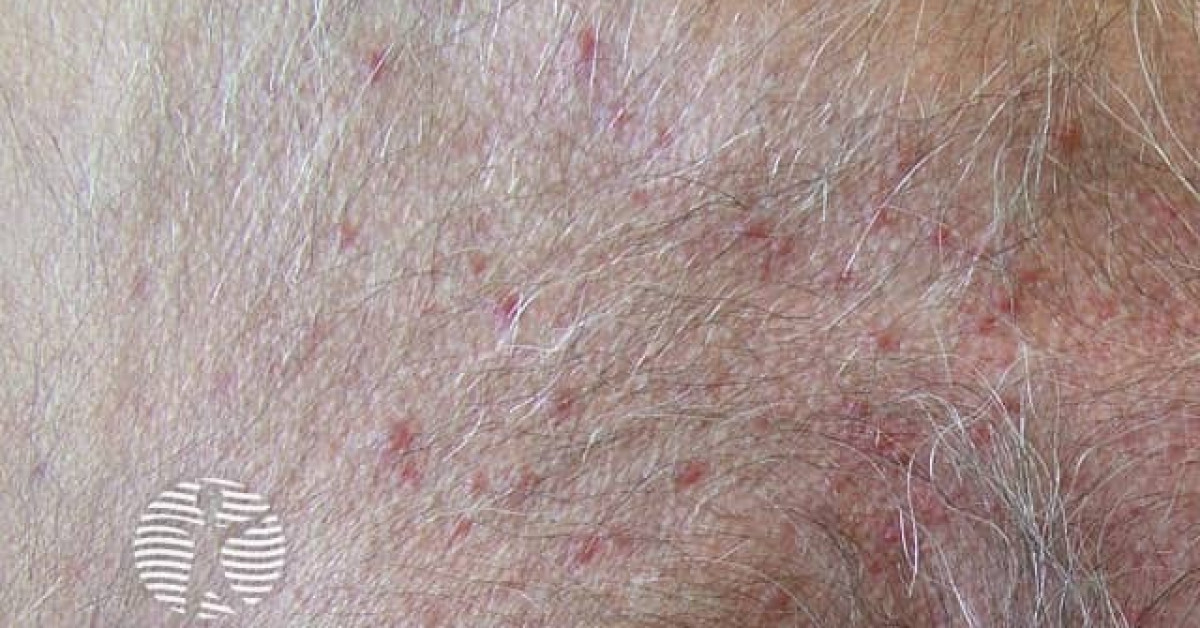 steroid-folliculitis.jpg image